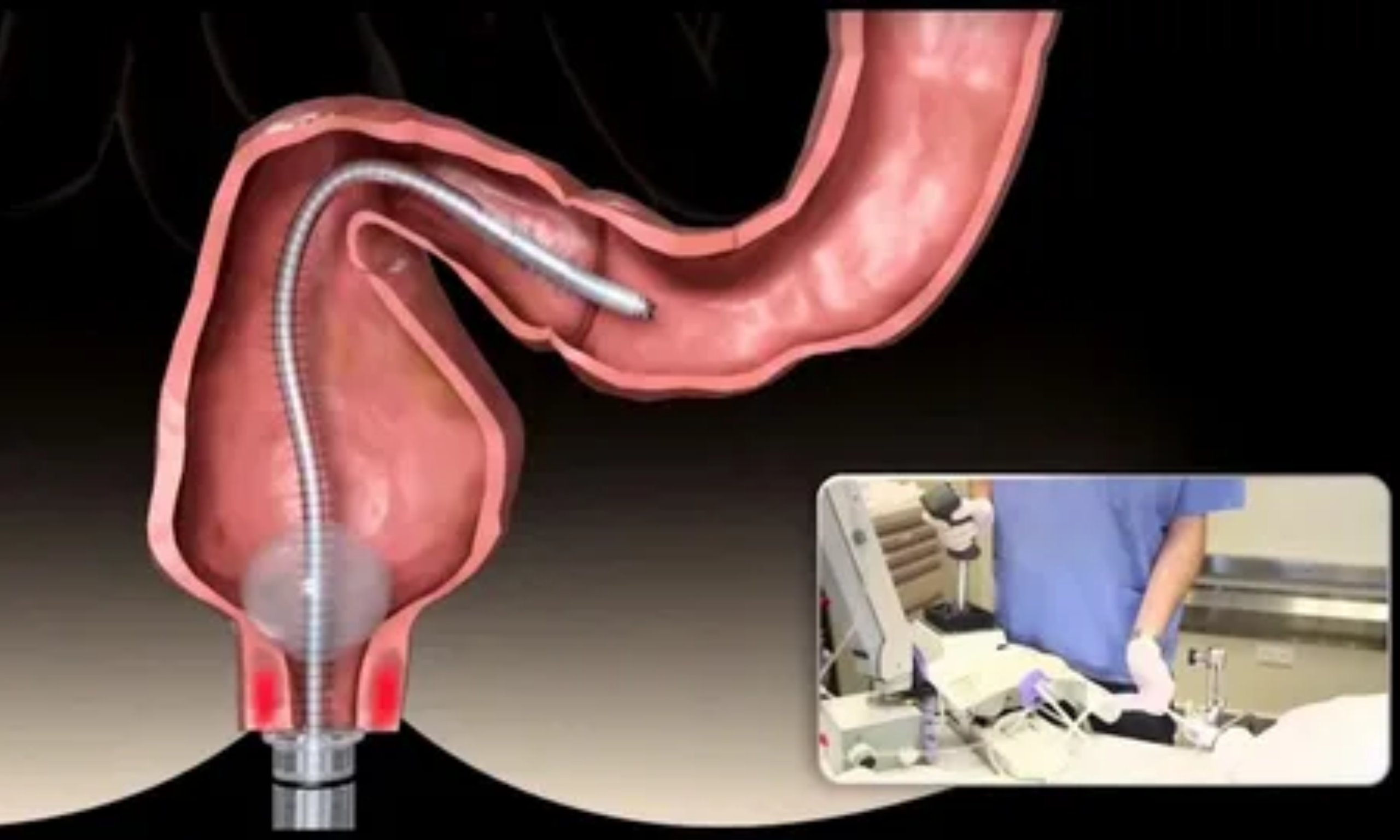 Benefits of Sigmoidoscopy for Colon Health Screening - Dr. Bhate
