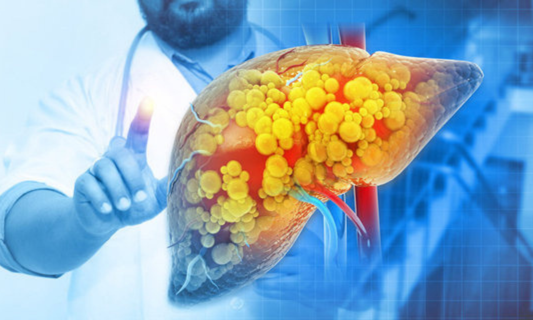 What Are the Typical Signs and Symptoms of Fatty Liver Disease? - Dr. Bhate